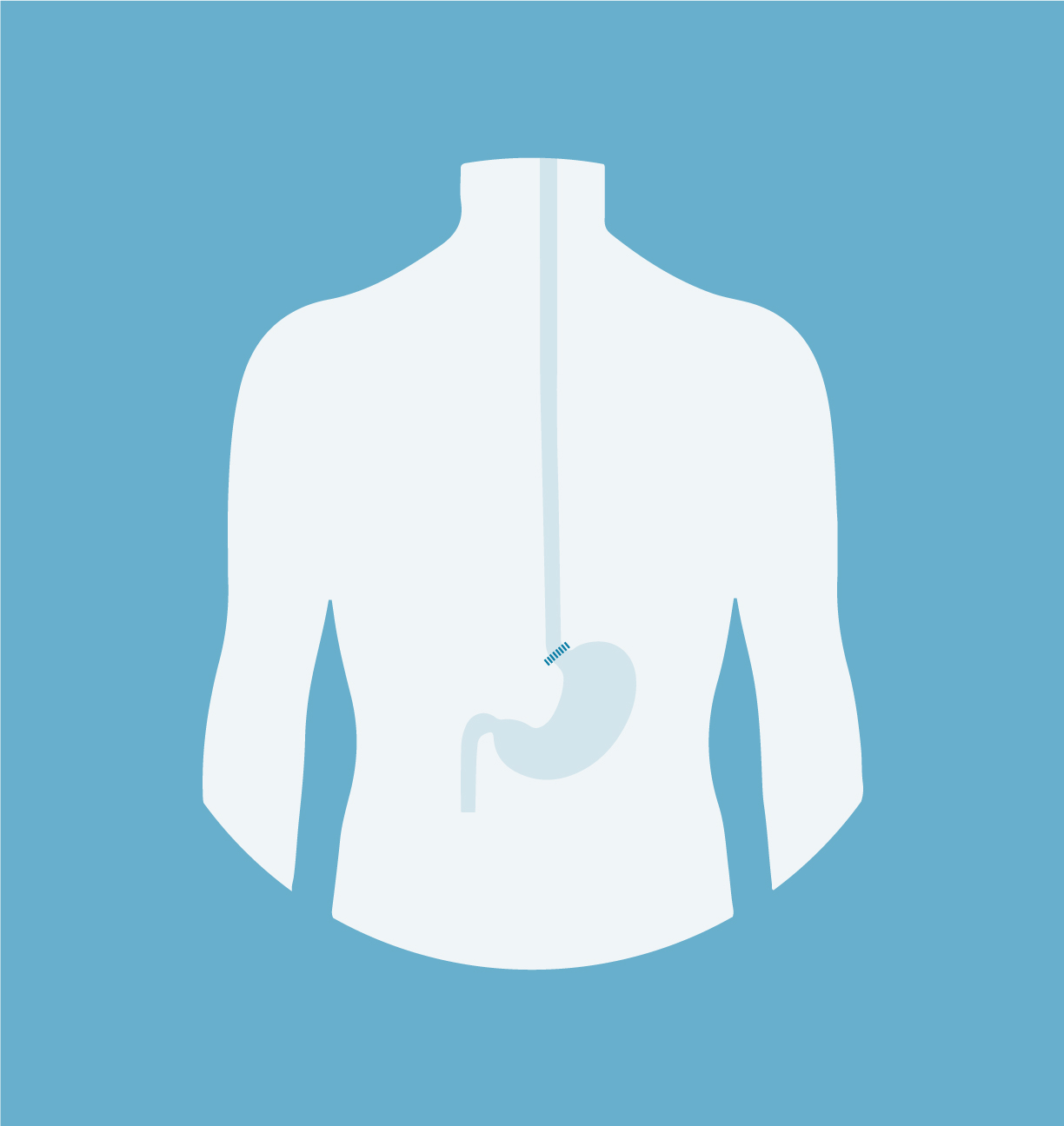 LINX® Sphincter Augmentation Surgery - Nicholas Boyle